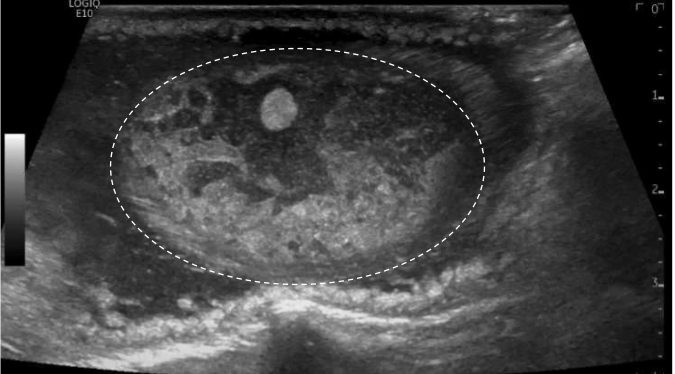 Necrotizing Enterocolitis Ultrasound