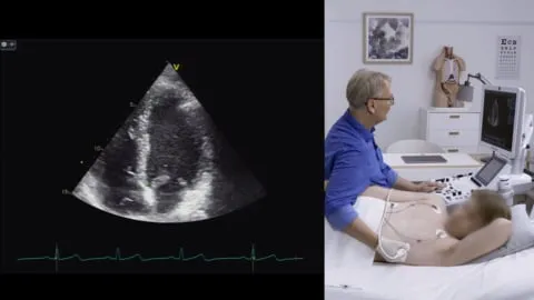 How can I measure the LV volume using the Simpson method? | 123sonography