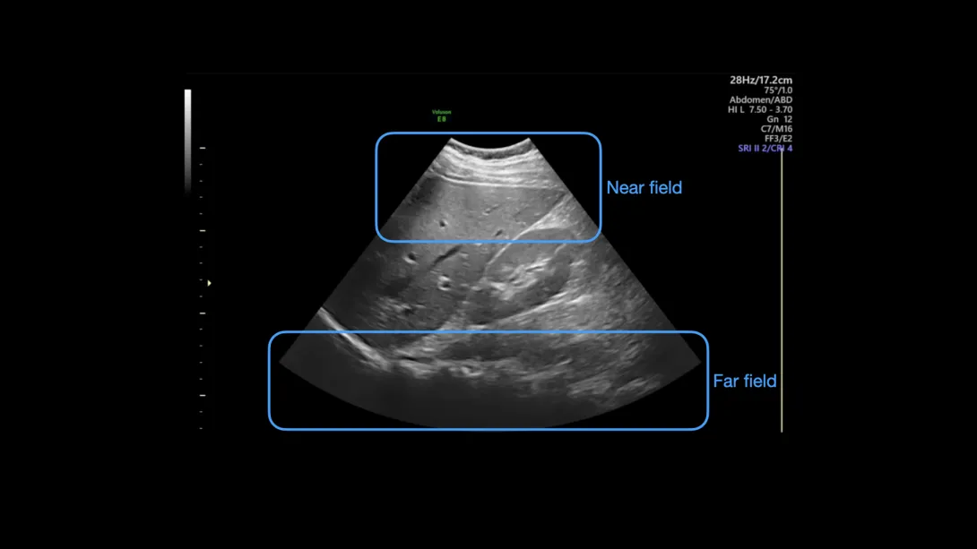 Ultrasound 101 – Part 11: Describing an Ultrasound Image | 123sonography